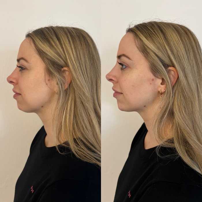 I Tried Facial-Balancing Fillers as Part of My Pre-Wedding Beauty Prep ...