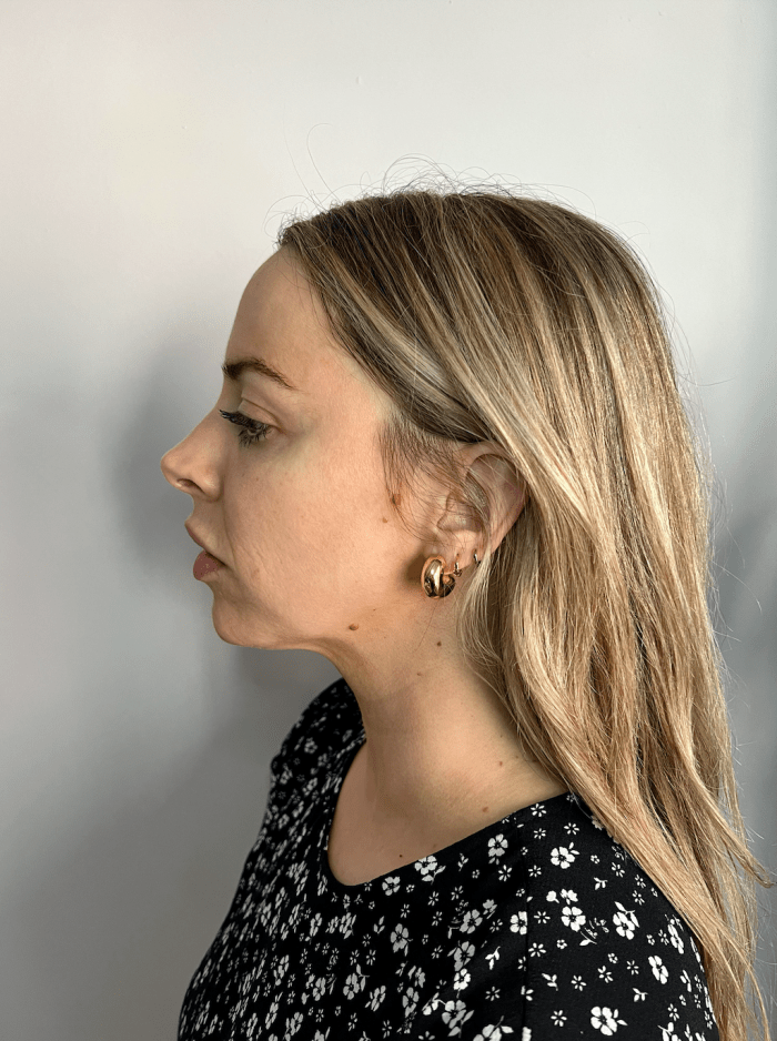 I Tried Facial-Balancing Fillers as Part of My Pre-Wedding Beauty Prep ...