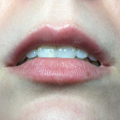 We Put 4 Noninvasive Lip Filler Alternatives to The Test - Fashionista